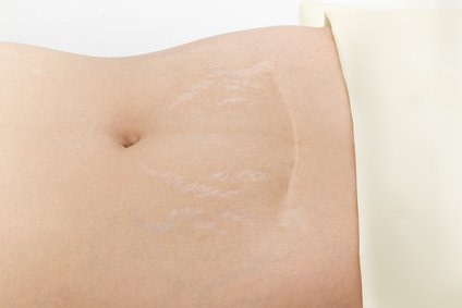 Narben behandeln - auch alte Narben